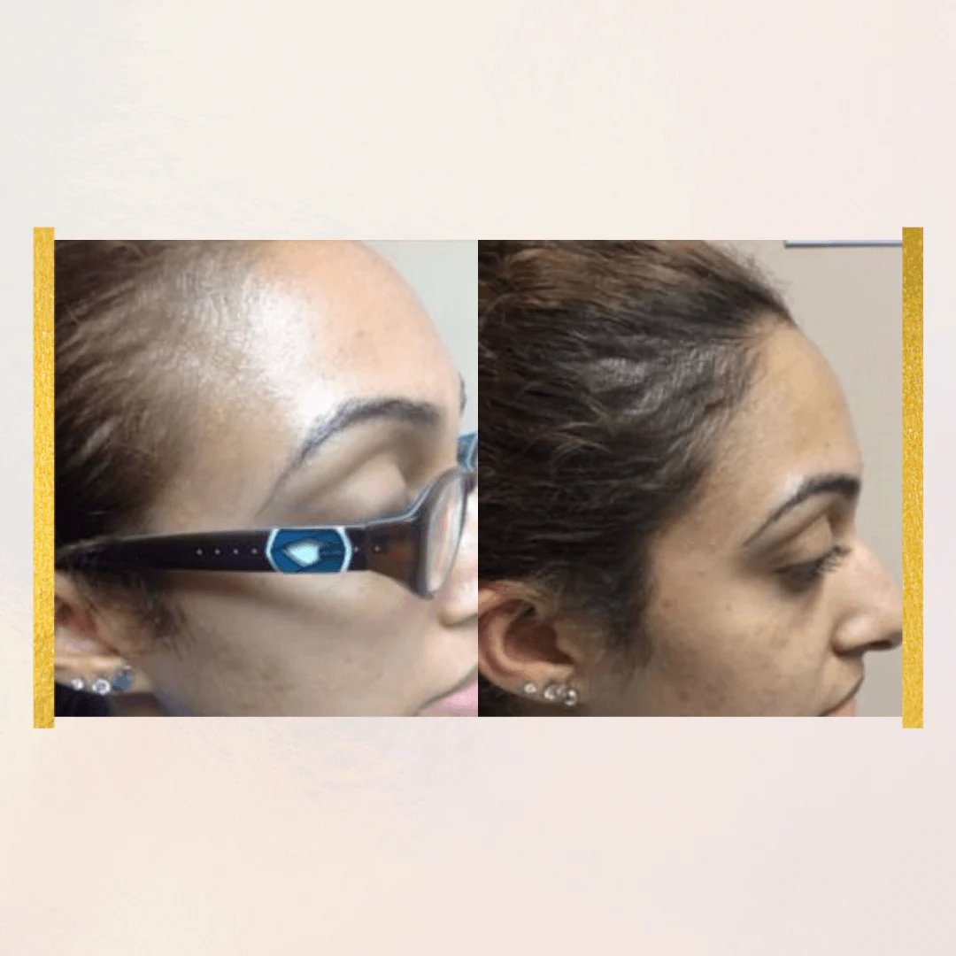 Thro-Grower Minoxidil 5% | Advanced Hair Regrowth