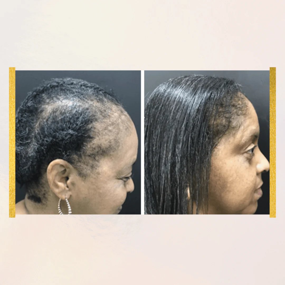 Thro-Grower Minoxidil 5% | Advanced Hair Regrowth